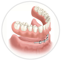 Implant Dentures | Denture Clinic in Southeast Calgary