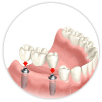 Implant Dentures | Denture Clinic in Southeast Calgary