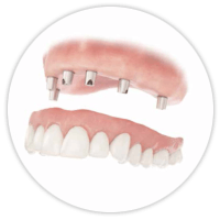 Implant Dentures | Denture Clinic in Southeast Calgary
